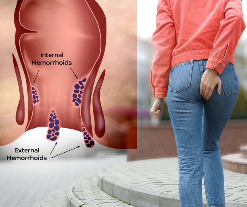 Prolapsed Internal Hemorrhoid