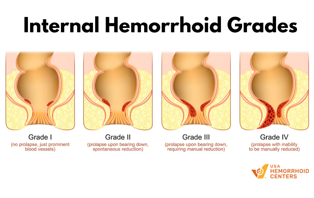 Hemorrhoid Grading System: Stages & Degree Classification