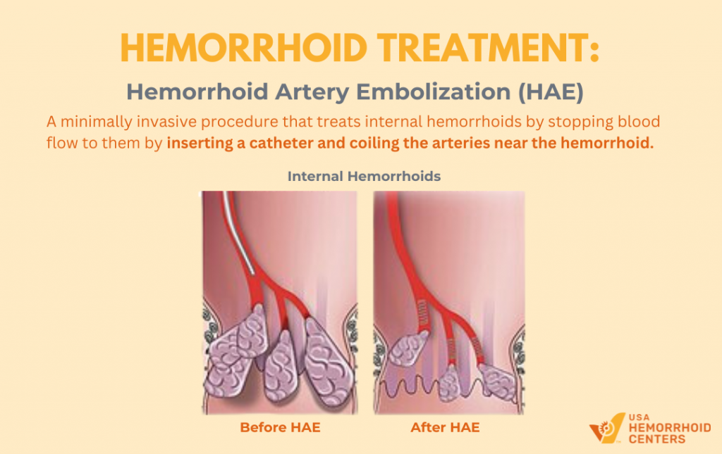 Can Hemorrhoids Come Back After Treatment? What You Need To Know | USA ...