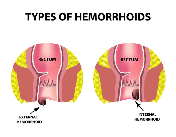 What Does A Hemorrhoid Look Like?